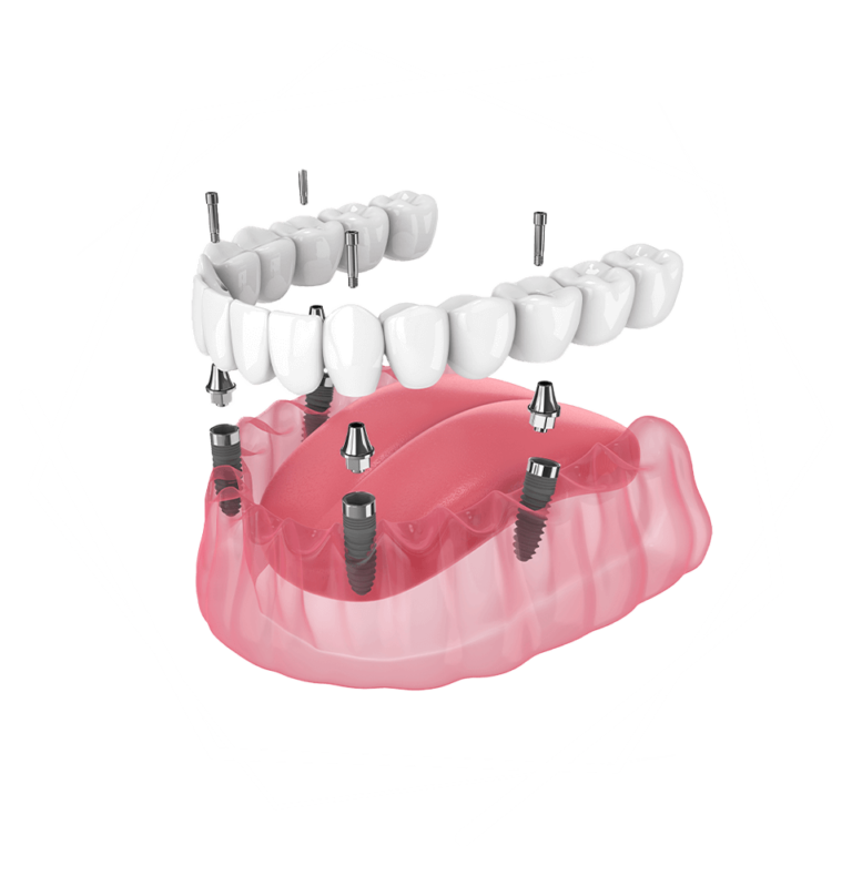 Union Dental Implant Center | Full Mouth Dental Implants | Austin, TX