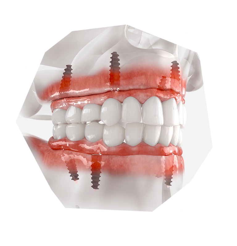 Union Dental Implant Center | Full Mouth Dental Implants | Austin, TX