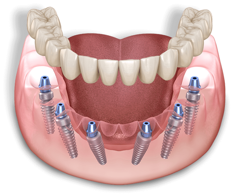 Union Dental Implant Center | Austin, TX | Full Mouth Dental Implants