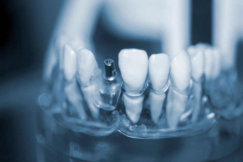 The Implant Tooth Process: What To Expect From Start To Finish | Union ...